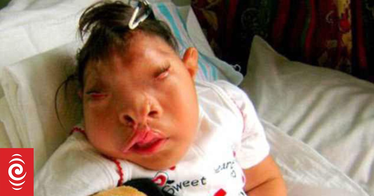 Samoa's miracle baby to be laid to rest in Samoa, aged 10 | RNZ