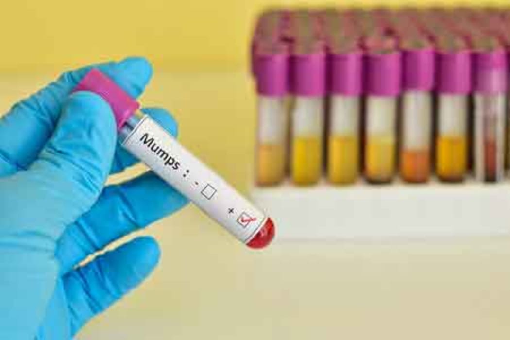 Warning in Tonga after mumps outbreak | RNZ News