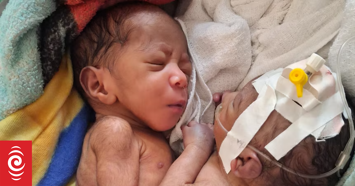 Conjoined boys born in PNG bound for Australia for medical treatment ...
