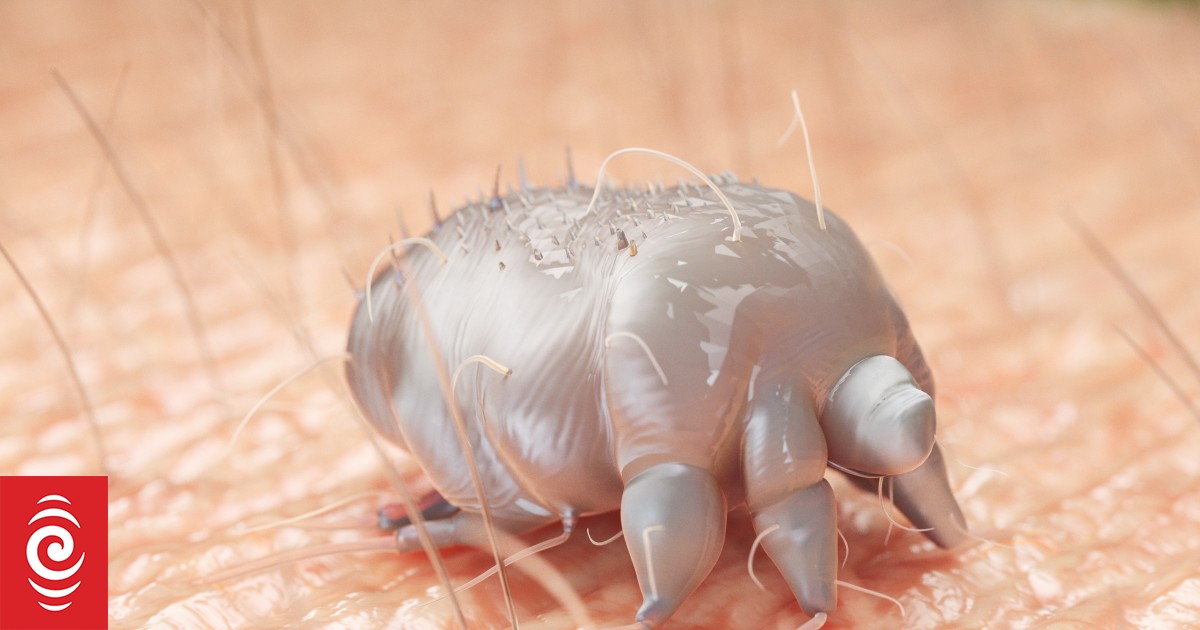 Scabies cases on rise across Canterbury | RNZ