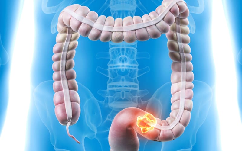 Phased roll-out of bowel screening urged | RNZ