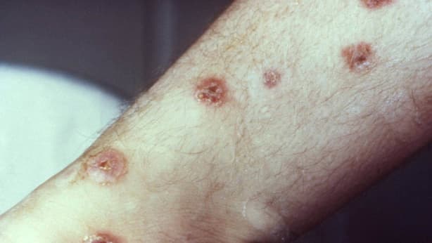 South Auckland's syphilis rise: 'It's not a new problem, but it's ...