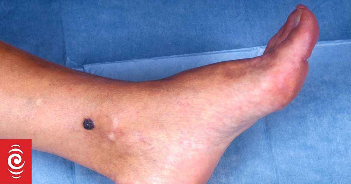 Right-arm moles flag melanoma risk | RNZ News