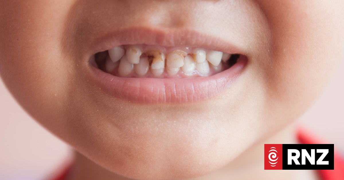 Two in five Auckland and Northland children have teeth cavities by age ...