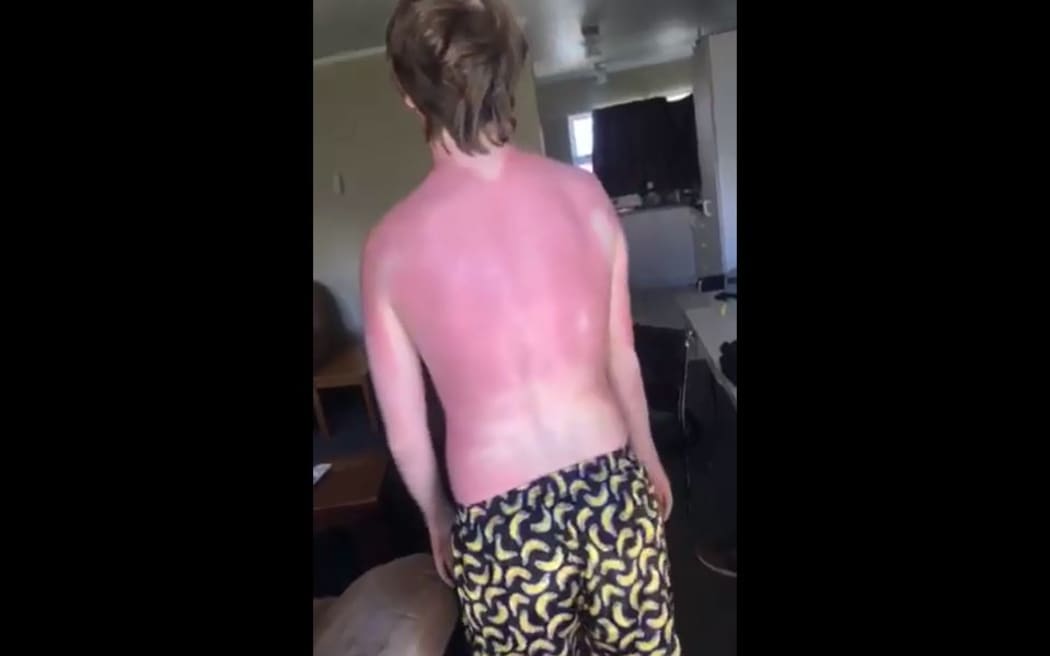redub sunburn
