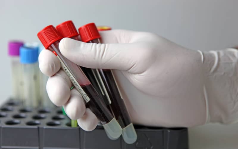 PNG HIV epidemic less generalised | RNZ