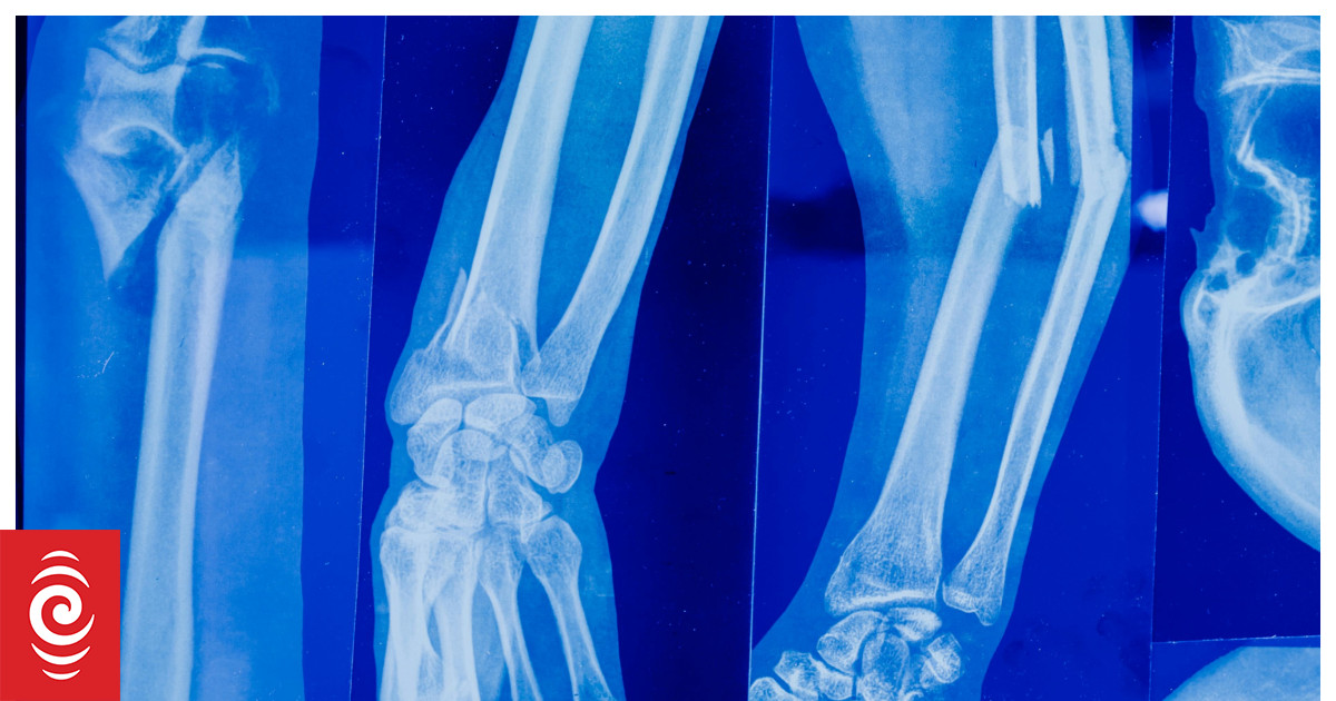 Decreasing bone fractures in people with osteoporosis | RNZ