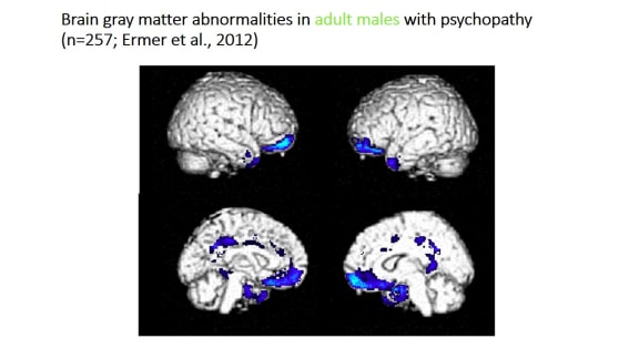 Inside the brains of psychopaths | RNZ