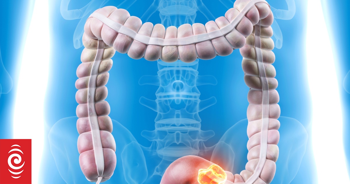 NZ team may have ID'd bowel cancer bug | RNZ News