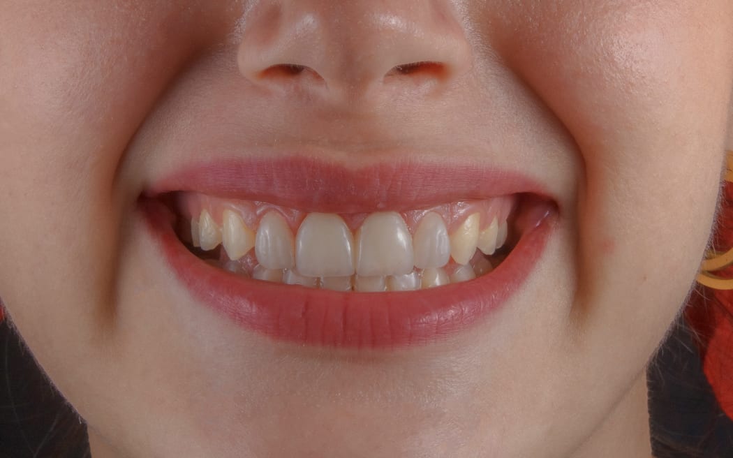 Dental expert Murray Thomson turns mythbuster over online advice | RNZ News