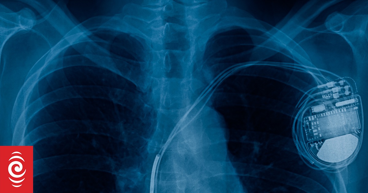 New pacemaker being tested in New Zealand | RNZ News